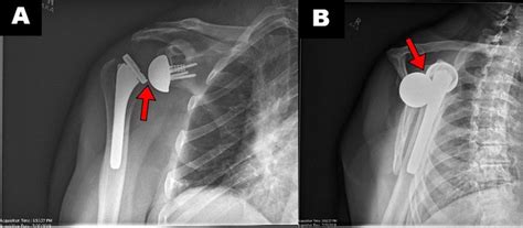 A 60 Year Old Male With Reverse Shoulder Arthroplasty Dislocation Download Scientific Diagram