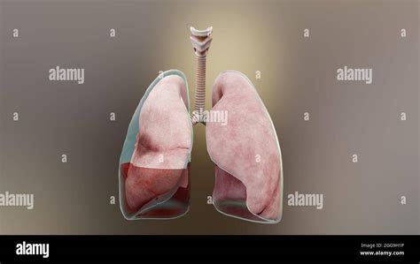 3d Illustration Of Hemopneumothorax Normal Lung Versus Collapsed