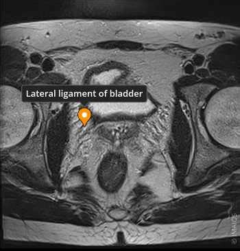 Lateral Ligament Of Bladder E Anatomy Imaios
