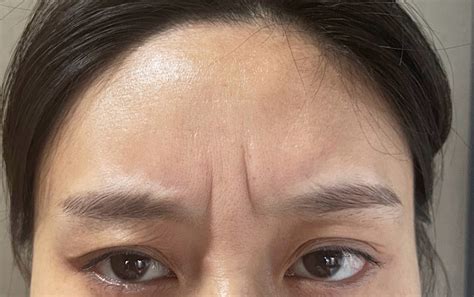 乐缇葆肉毒川字纹、抬头纹