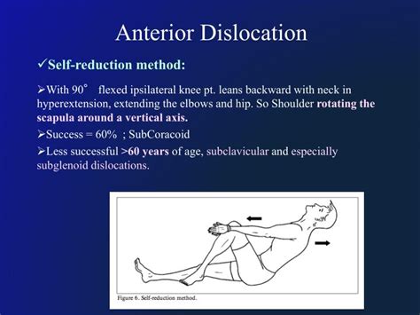 Ppt Shoulder Dislocation Powerpoint Presentation Id4841498