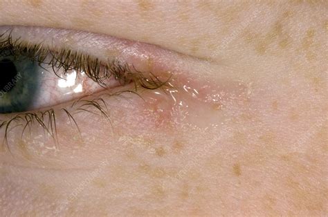 Eye Herpes Herpes Symptoms Causes Types Treatments Emergency