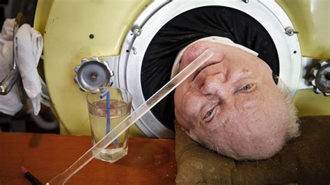Paul Alexander Who Spent More Than 70 Years Living In An Iron Lung
