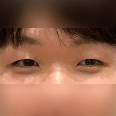 발품후기 남자 쌍커풀수술 5 강남언니 1등 성형수술and피부시술 정보앱