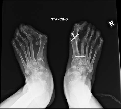 Metatarso Desmoid Fibroma Of The Foot Oncosurgery