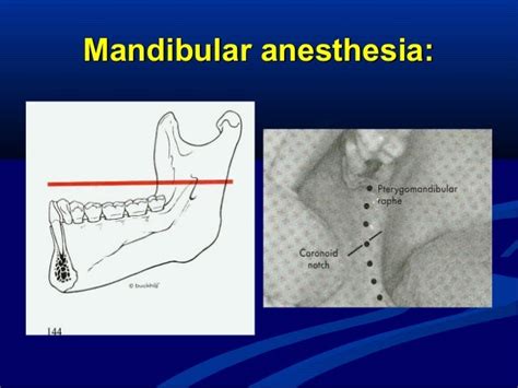 Mandibular Local Anesthesia