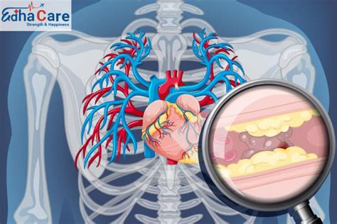 Myocardial Bridging