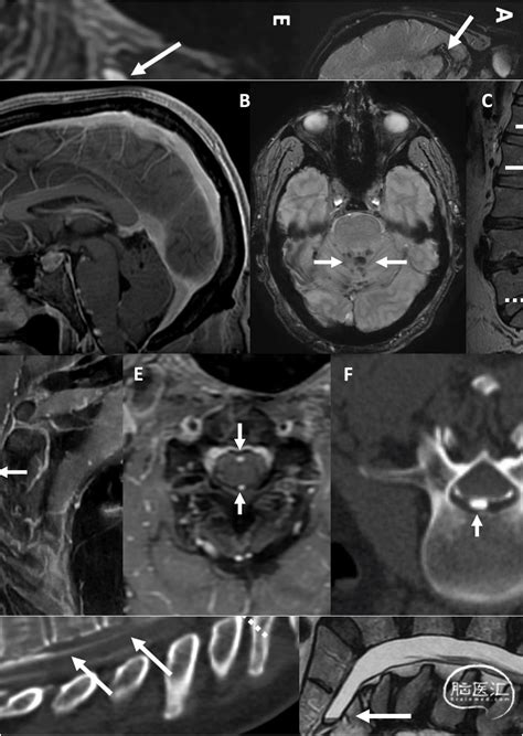 Neuroradiology：低颅压的少见影像学表现 脑医汇