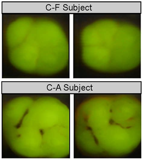 Caries Phenotype Determination Quantitative Light Fluorescence Qlf