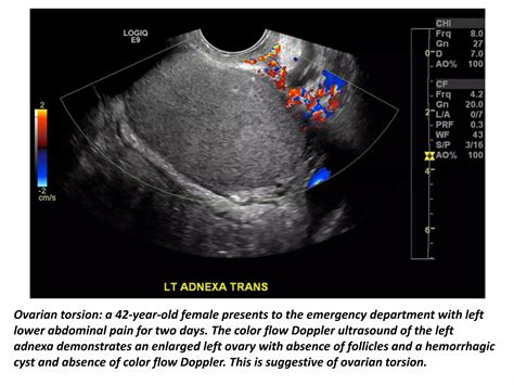 Presentation11 Radiological Imaging Of Ovarian Torsion Ppt