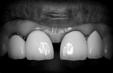 Cambio de prótesis desadaptadas y o aspecto artificial Cosmética Dental Burga