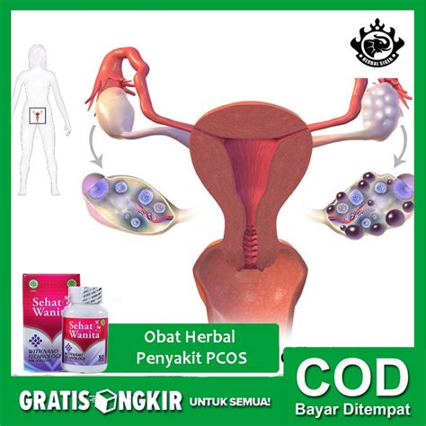 Jual Obat Herbal Penyakit Pcos Sindrom Ovarium Polikistik Sehat