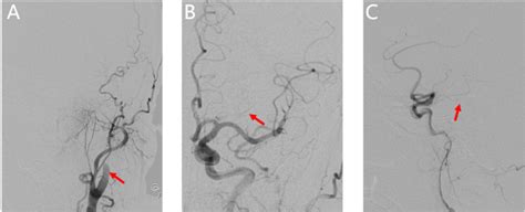 Features Of The Emergency Digital Subtraction Angiography DSA A Download Scientific