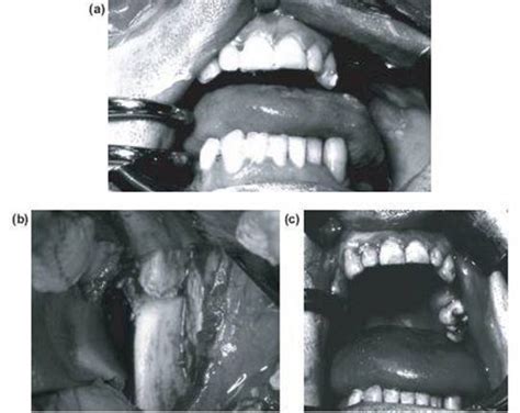 Ankylosis Of The Temporomandibular Joint Fundamentals Of Orthognathic