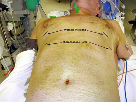 Lung Surgery For Collapsed Lung