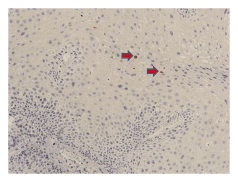 Initial Biopsy During The First Visit A Vacuolar Degeneration In