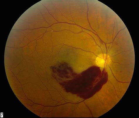 25 Best Retina Images On Pinterest Optometry Backgrounds And Eyes