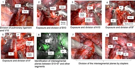 A Robotic Right Posterior Basal And Subsuperior S10s∗ Segmentectomy