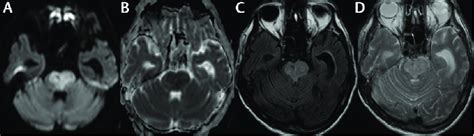 Magnetic Resonance Imaging MRI Brain A B Diffusionweighted Image