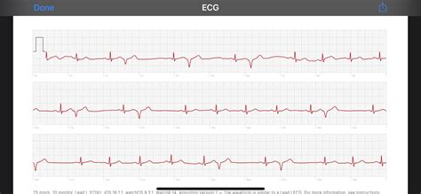 Pvcs Happening For A Week Almost Every Night Before Bed And Driving Me