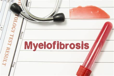 Navitoclax Plus Ruxolitinib Effectively Reduces Splenomegaly In Patients With MF Docwire News