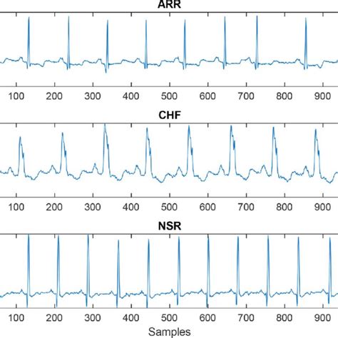 Pdf Classification Of Normal Sinus Rhythm Abnormal Arrhythmia And