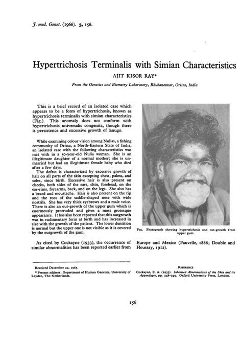 Hypertrichosis Terminalis With Simian Characteristics Journal Of