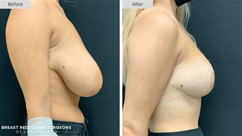 Breast Reduction Surgery Before And After Photos In Long Island