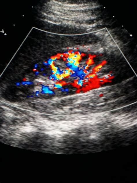 What Do Red And Blue Colors Mean On An Ultrasound