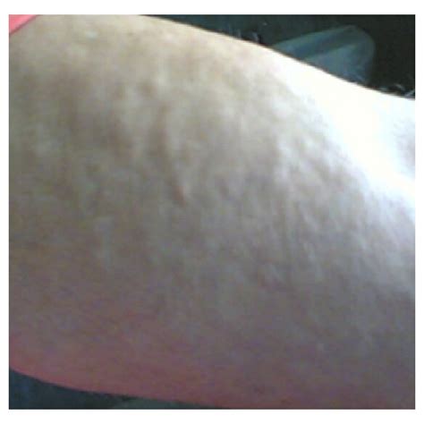 Diffuse Maculopapular And Nodular Rash On The Upper Limbs A And Trunk Download Scientific