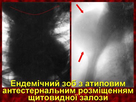 Захворювання щитоподібної залози презентация онлайн