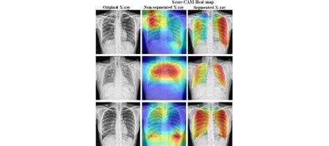 Reliable Tuberculosis Detection Using Chest X Ray With Deep Learning Segmentation And