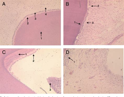 Figure 1 From Histological Comparison Of Pulpal Inflammation In Primary