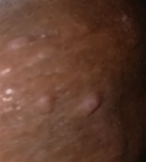 Ask A Dermatologist Online For Don T Know If Its Genital Warts Or Bumps