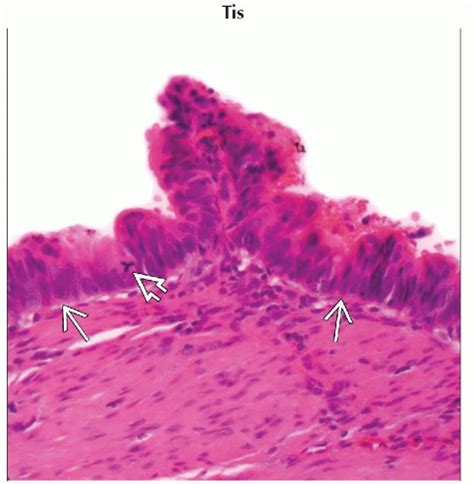 Gallbladder Carcinoma Radiology Key