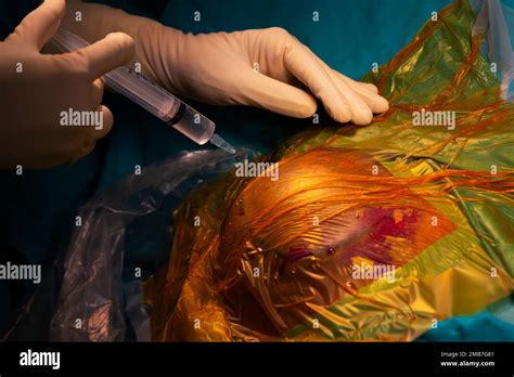 Neurosurgeon Injecting Local Anesthesia On The Scalp During Brain