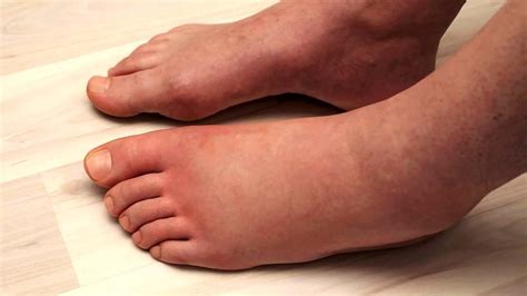 Here Are 6 Underlying Causes Of Swollen Legs And How To Fix Them