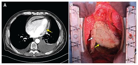 Constrictive Pericarditis With Pericardial Calcification Cmaj