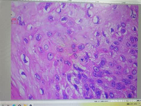 病理学实验切片——上皮组织恶性 肿瘤鳞状细胞癌 知乎