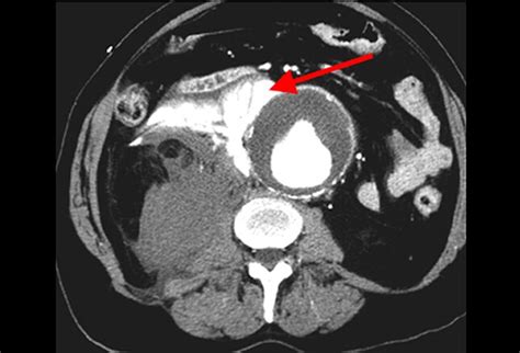 14 Mimics Of Appendicitis