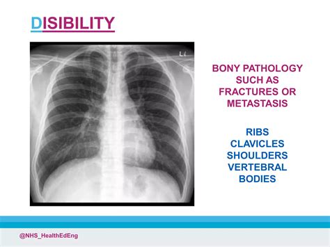 Abcde Cxr Final Version Pptx