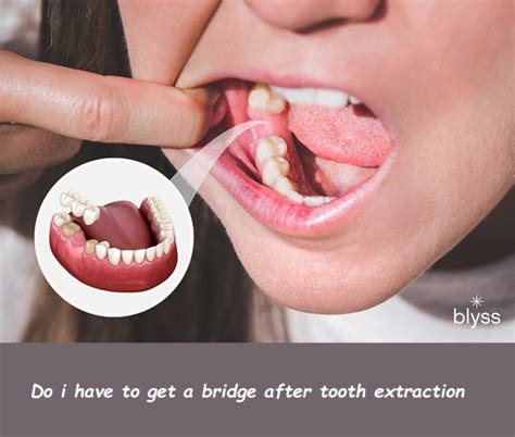 Do I Have To Get A Bridge After Tooth Extraction