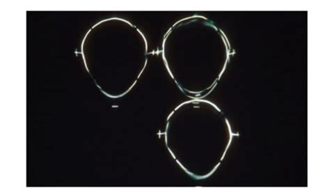 Objective Vs Subjective Refraction 3 1 Flashcards Quizlet