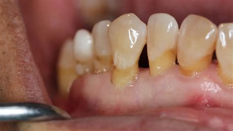 Retração Gengival Saiba As Causas Sintomas E Como Prevenir