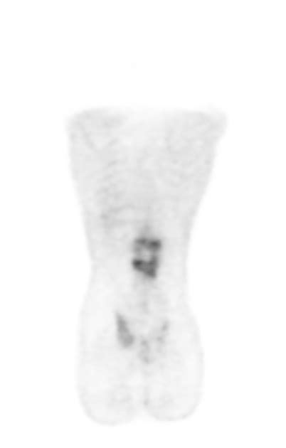 Spinal Epithelioid Angiosarcoma Image