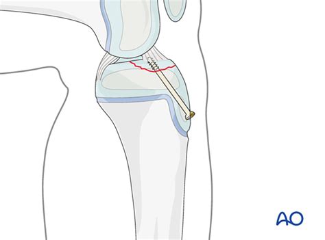 Arthroscopically Assisted Screw Fixation For Avulsion Of The Tibial Spine