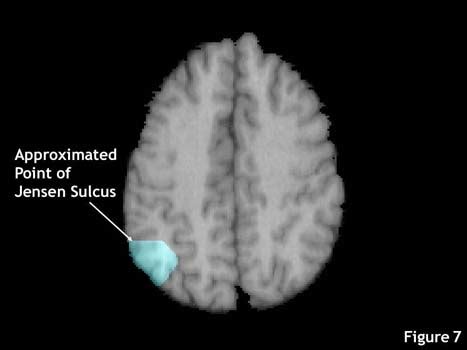 Angular Gyrus