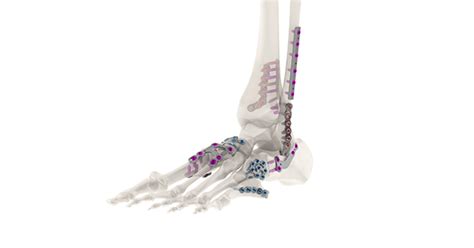 Tyber Medical Gains 510 K For Anatomical Plating Orthoworld