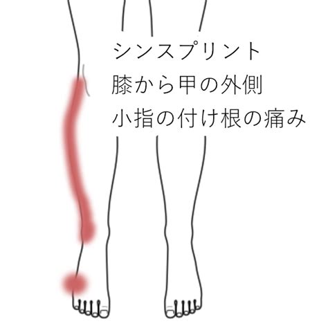 小指の付け根の外側から、スネ、膝の外側にかけての痛み（シンスプリント）｜下腿の痛みのツボ｜ツボネット 鍼灸の症例が検索できるツボ辞典