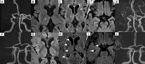 Negative Flair Vascular Hyperintensities Serve As A Marker Of No